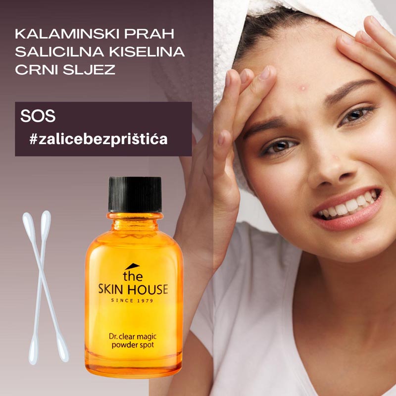 Svaki drugi tinejdžer ima prištiće, a ovo je tretman koji rješava problem!